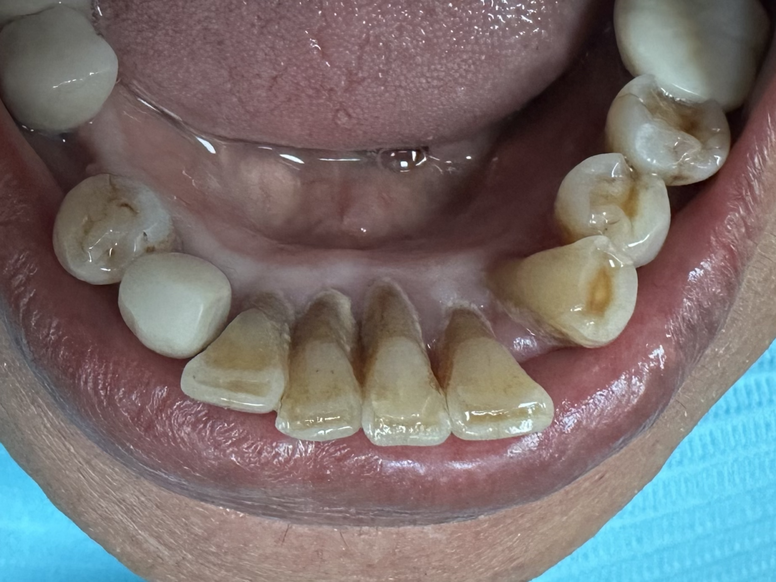 Multiple Extractions and Immediate Placement of Implants with a ...