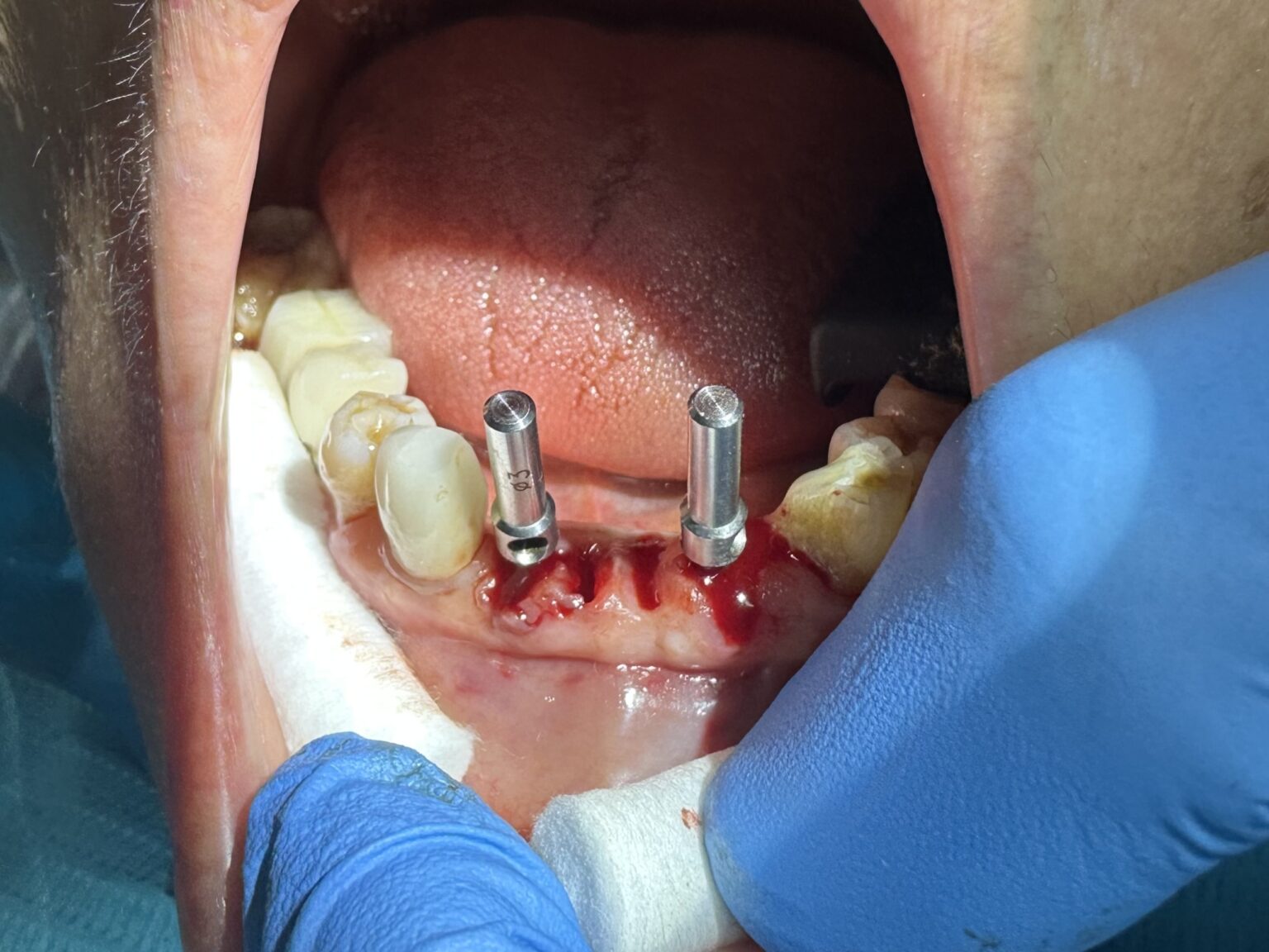 Multiple Extractions and Immediate Placement of Implants with a ...