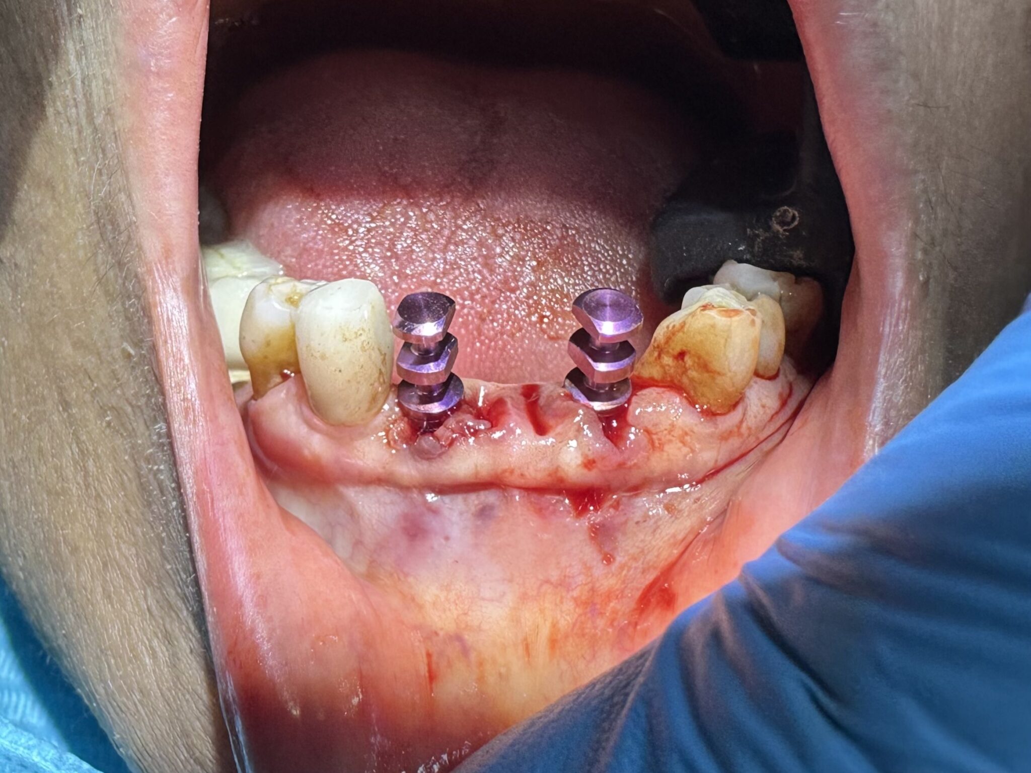 Multiple Extractions and Immediate Placement of Implants with a ...